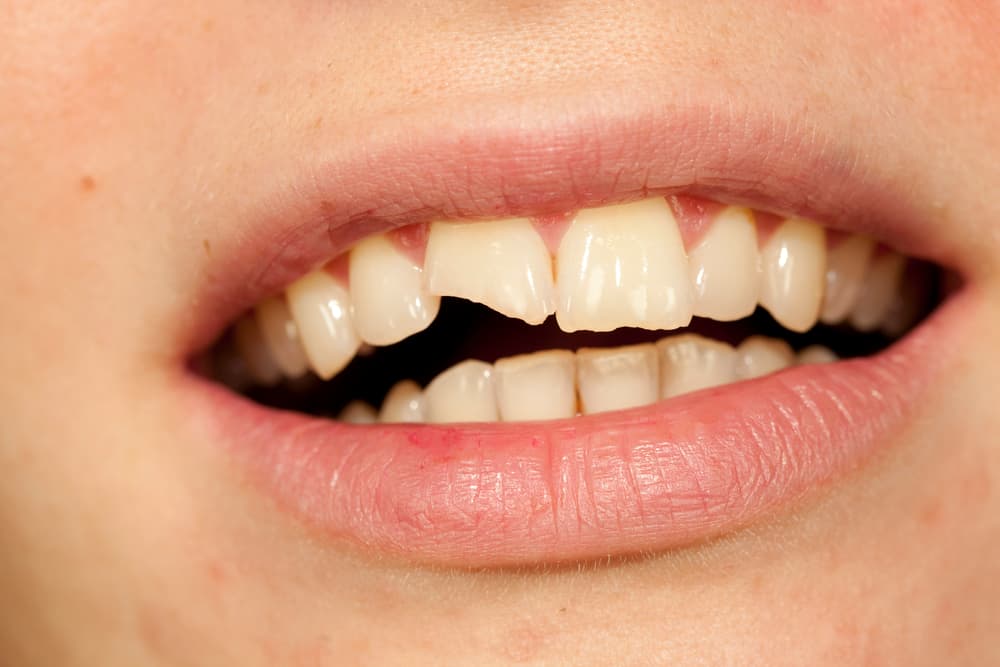 Jagged Teeth: Causes & 6 Ways To Fix Them | Longevita Dental