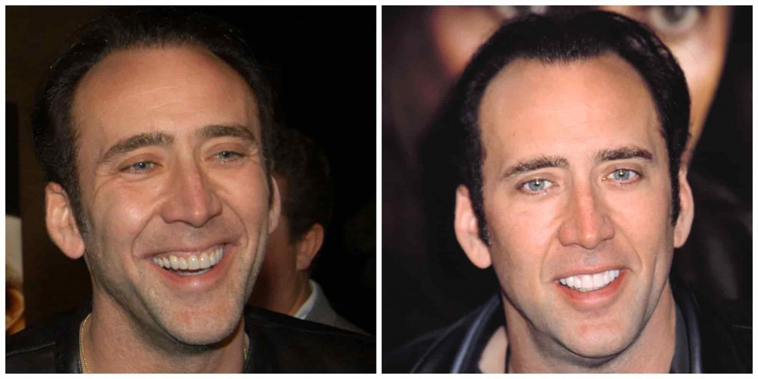 Which Celebrities Have Veneers? | Longevita Dental