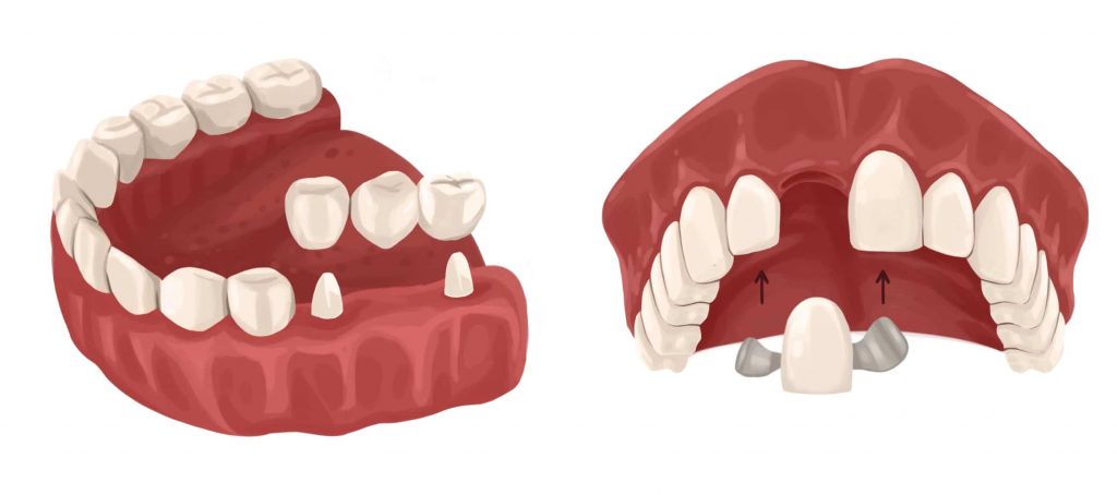 Maryland Dental Bridge: Pros, Cons & Cost | Longevita