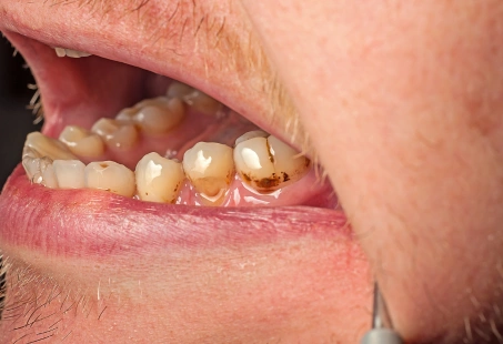 Brown Spots On Teeth: The Reasons & Treatments | Longevita