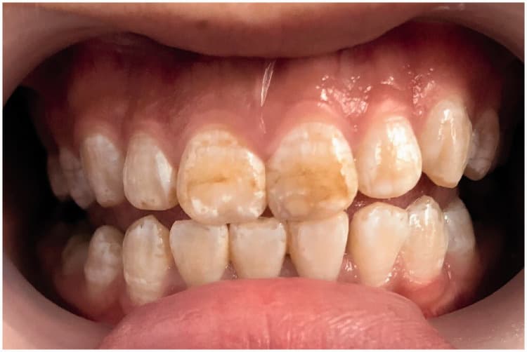 Brown Spots On Teeth: The Reasons & Treatments | Longevita